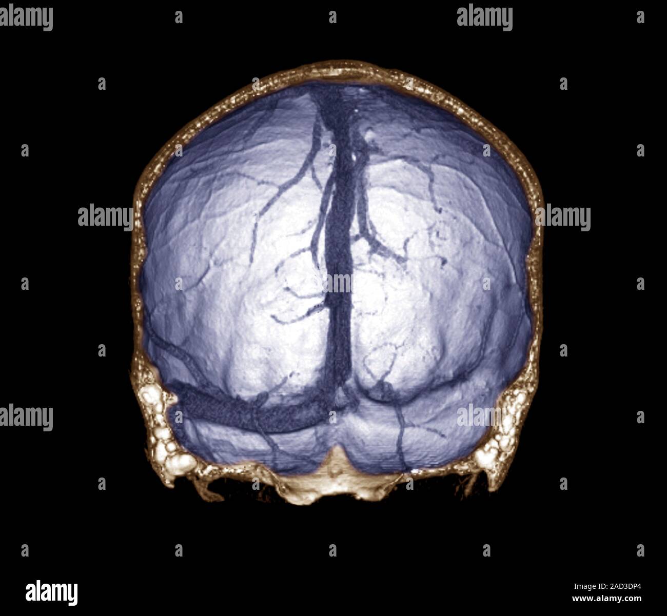 Thrombophlebitis of the brain. Coloured 3D computed tomography (CT) scan showing the cerebral ...