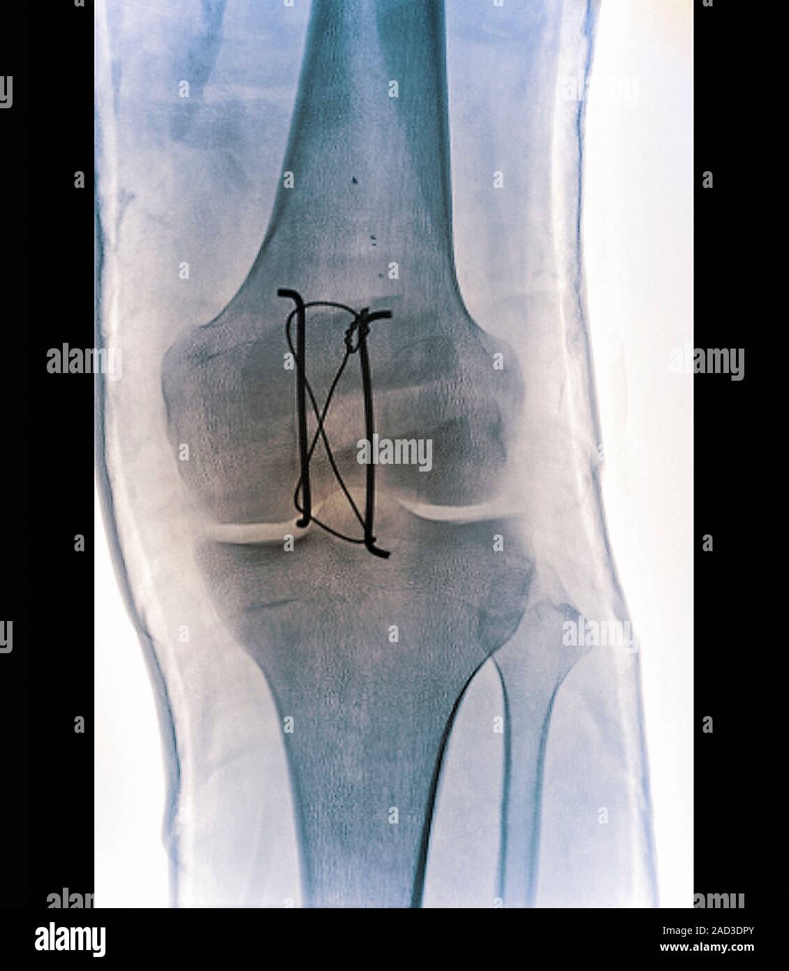 Pinned kneecap fracture. Coloured frontal X-ray of a section through ...