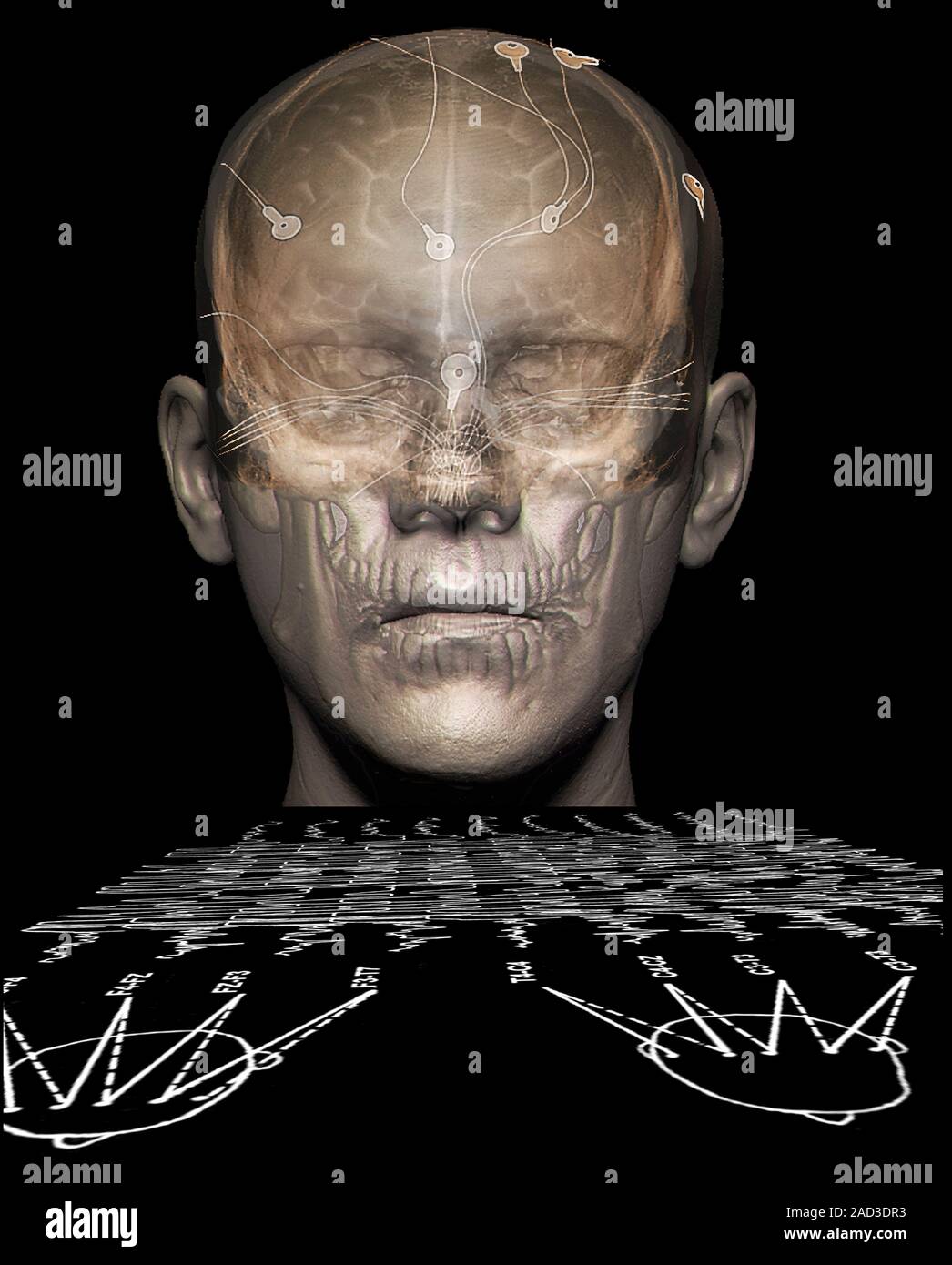 Electroencephalography. Composite image of a coloured 3D computed ...