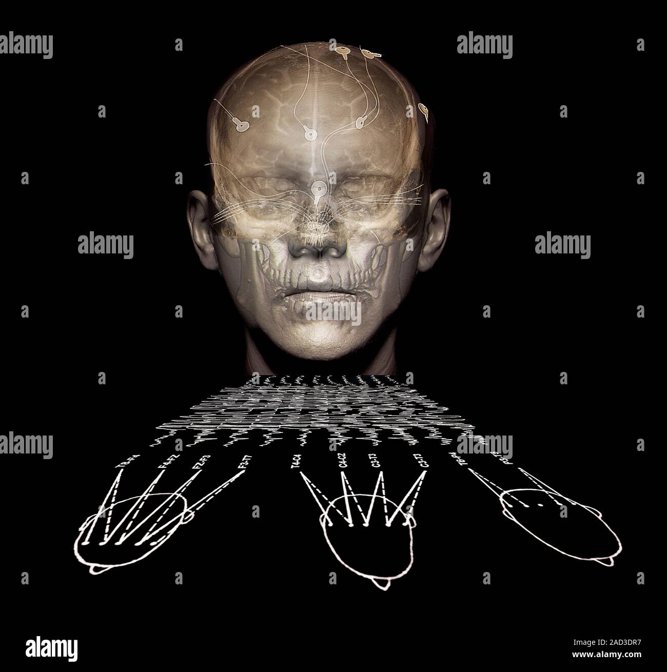 Electroencephalography. Composite image of a coloured 3D computed ...