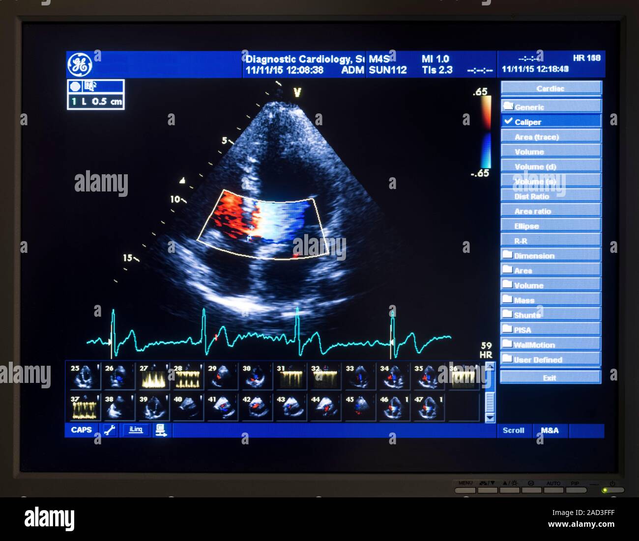 Doppler echocardiography scan. This scan has been acquired during tests ...
