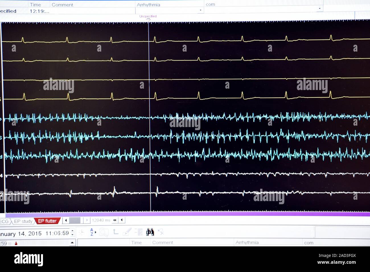 Heart surgery electrophysiology screen. Electrical traces on a screen ...