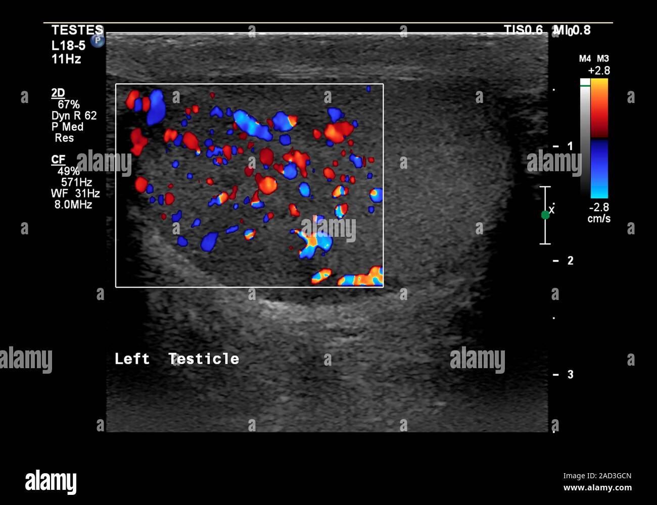 Doppler ultrasound scan of the left testicle of a 29 year old man with ...