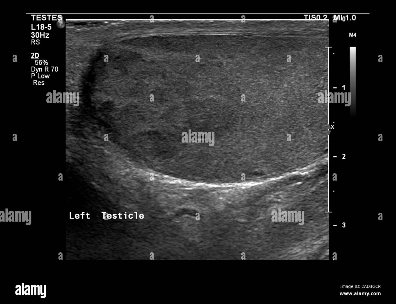 Ultrasound scan of the left testicle of a 29 year old man with ...
