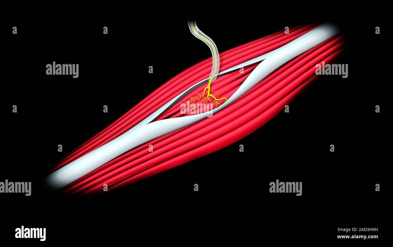 Stretch reflex mechanism. Computer illustration showing the muscle and ...