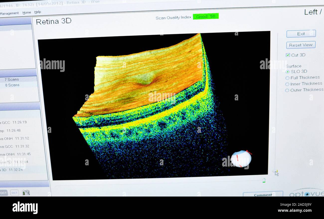 Retinal scan testing for glaucoma. 3D scan of the retina of an eye in a ...