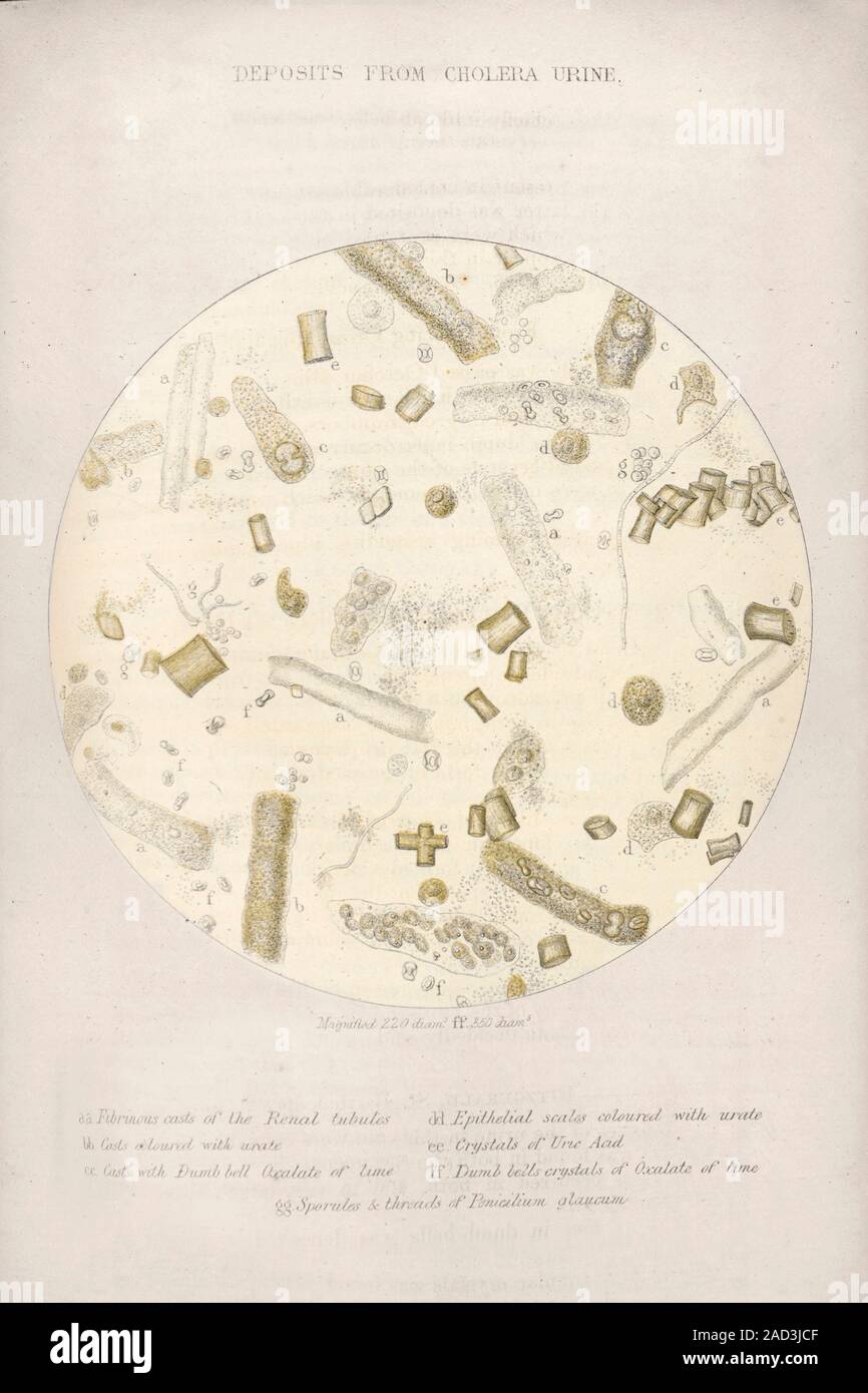 Cholera epidemic research. Illustration of a microscope view of ...