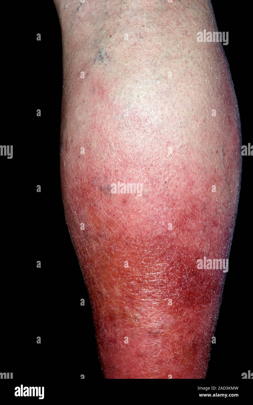 Cellulitis following toe injury. Close-up of the swollen lower leg of a ...