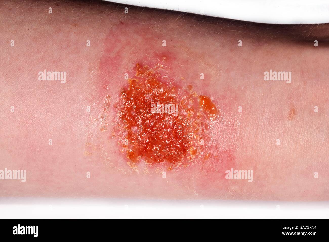 Infected burn. Close-up of an infected burn on the forearm of a 24-year ...