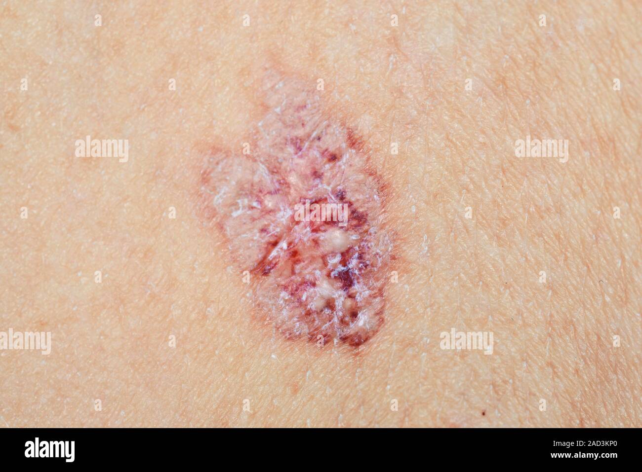 Lichen sclerosus. Close-up of a lesion on the chest of a 52-year-old ...