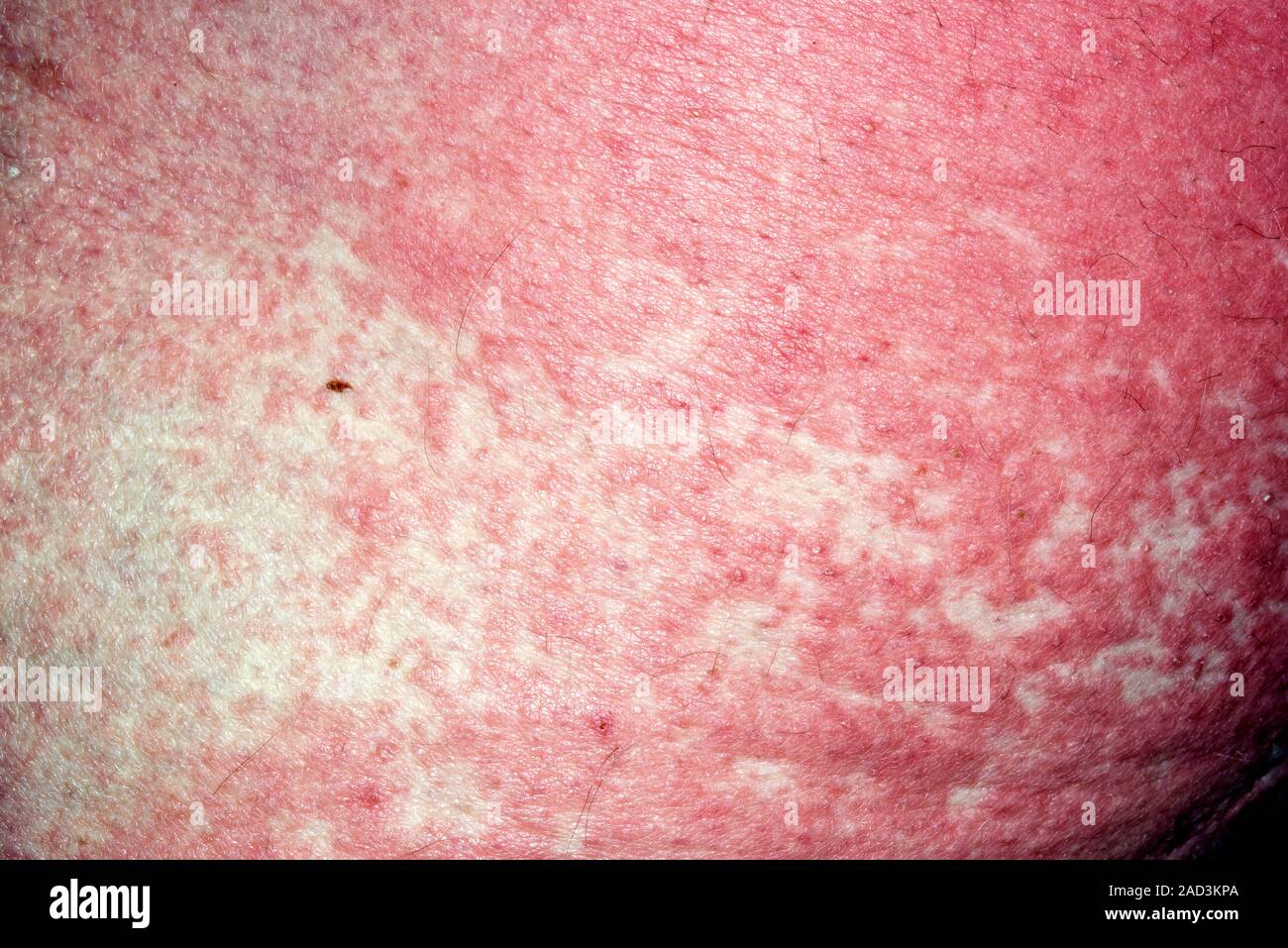 Skin peeling in allergic reaction. Close-up of desquamation (skin ...