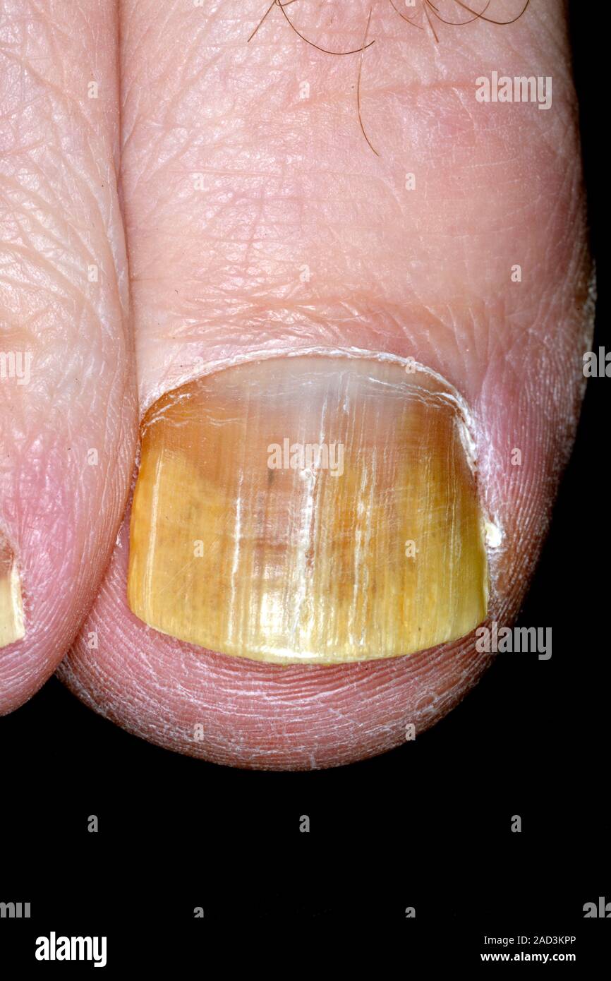 Fungal nail infection after treatment. Close-up of the toenail of a 62 ...
