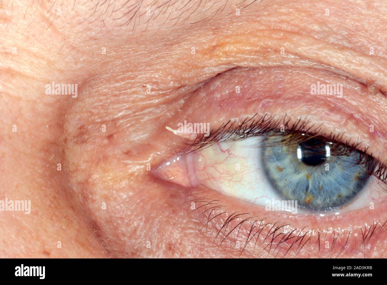 Cutaneous Horn Images | Cutaneous Horn of the Eyelid: Anatomoclinical ...