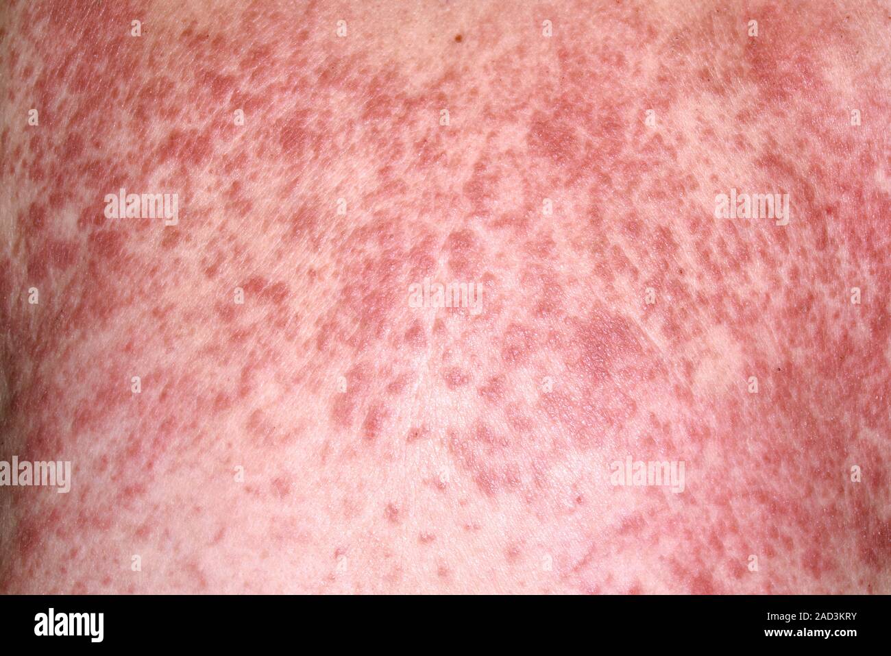 Bullous pemphigoid. Close-up of a rash on the skin of an 80-year-old ...