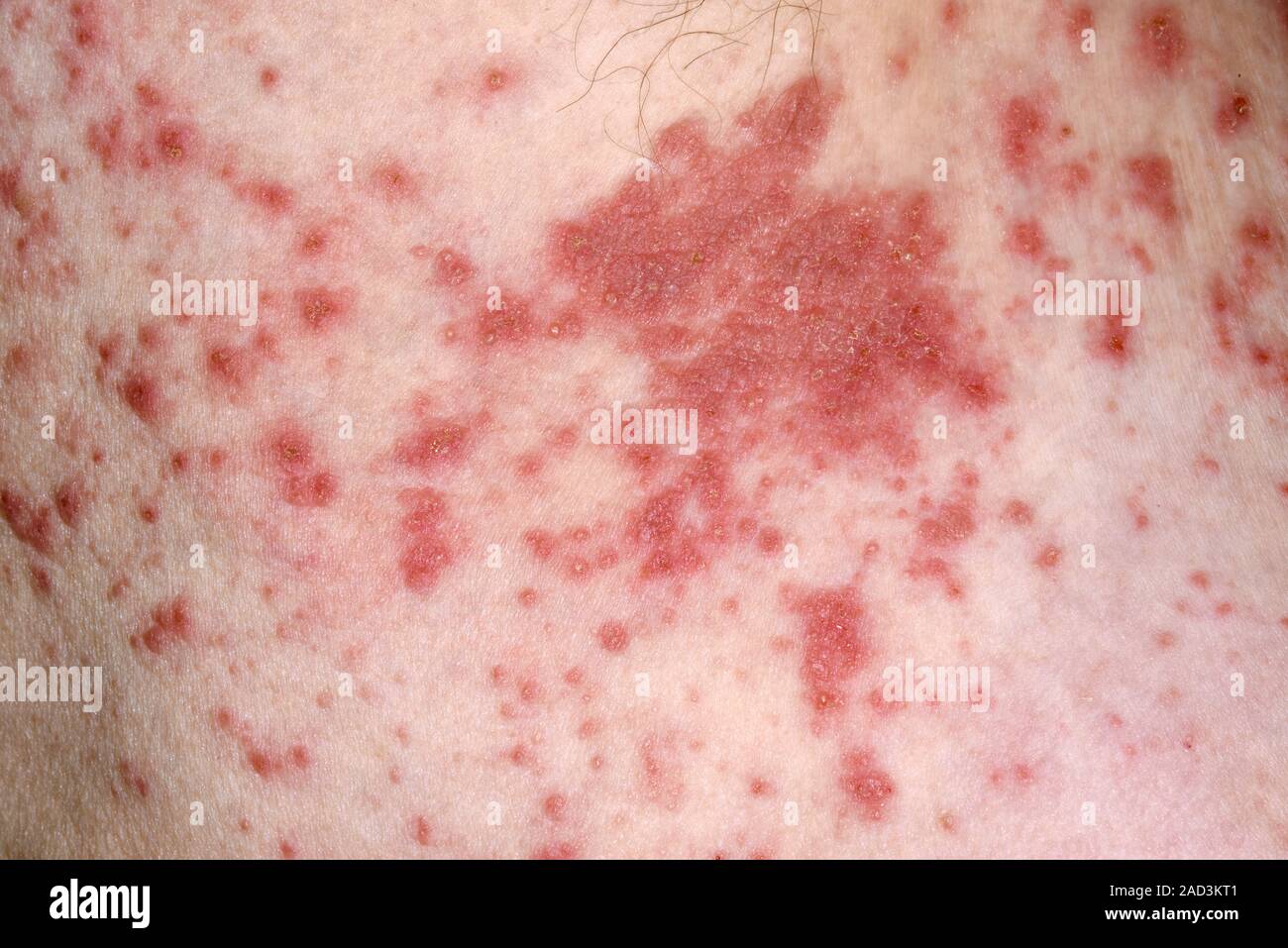 Bullous pemphigoid. Close-up of a rash on the skin of an 80-year-old ...
