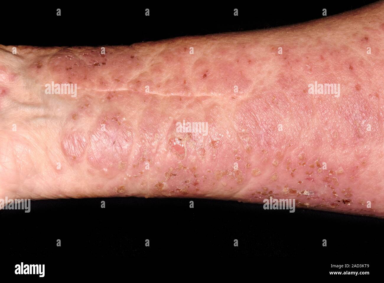 Bullous pemphigoid. Close-up of a rash on the arm of an 80-year-old ...