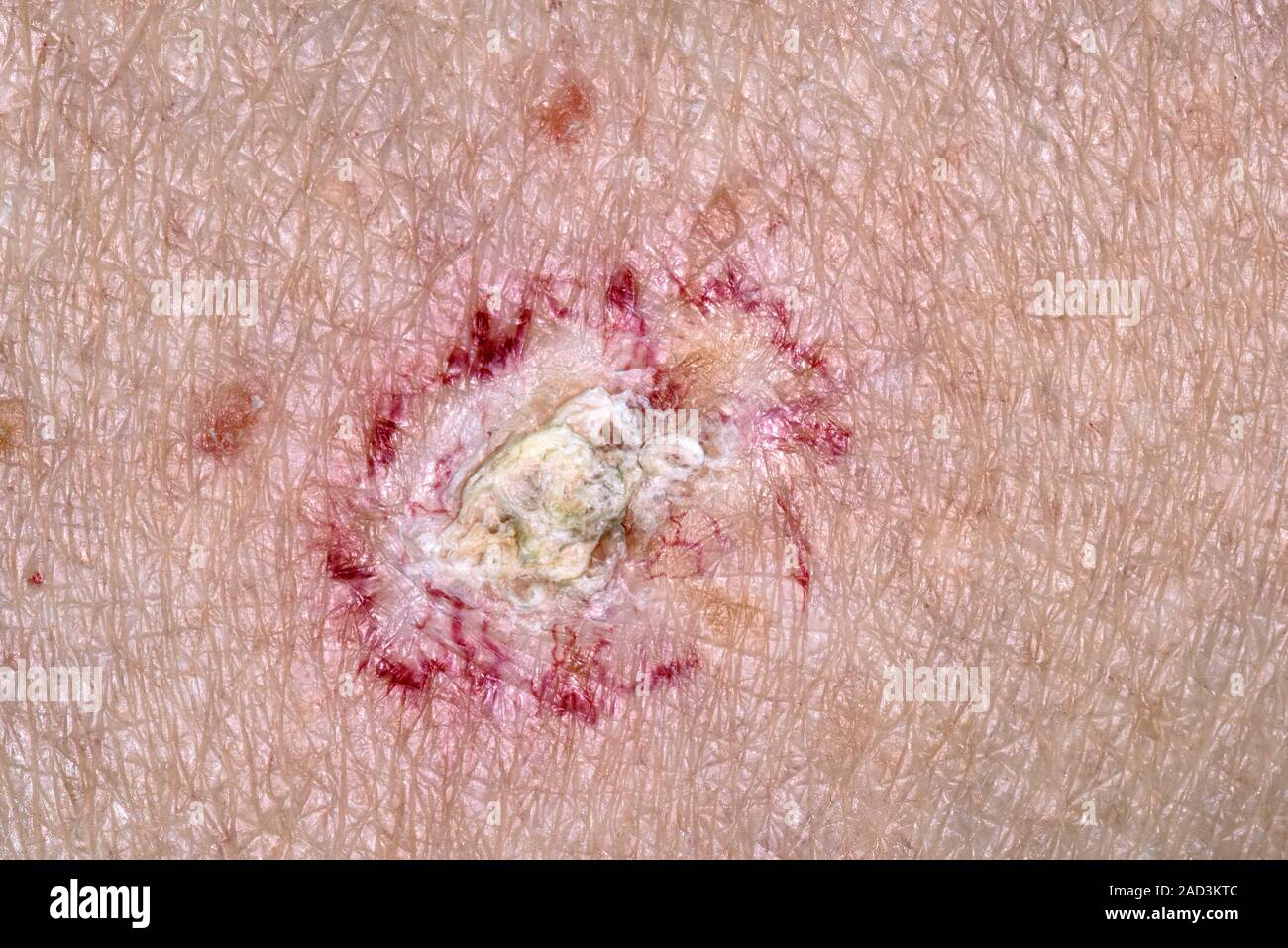 Bowen's disease skin cancer. Close-up of a lesion on the forearm of an ...