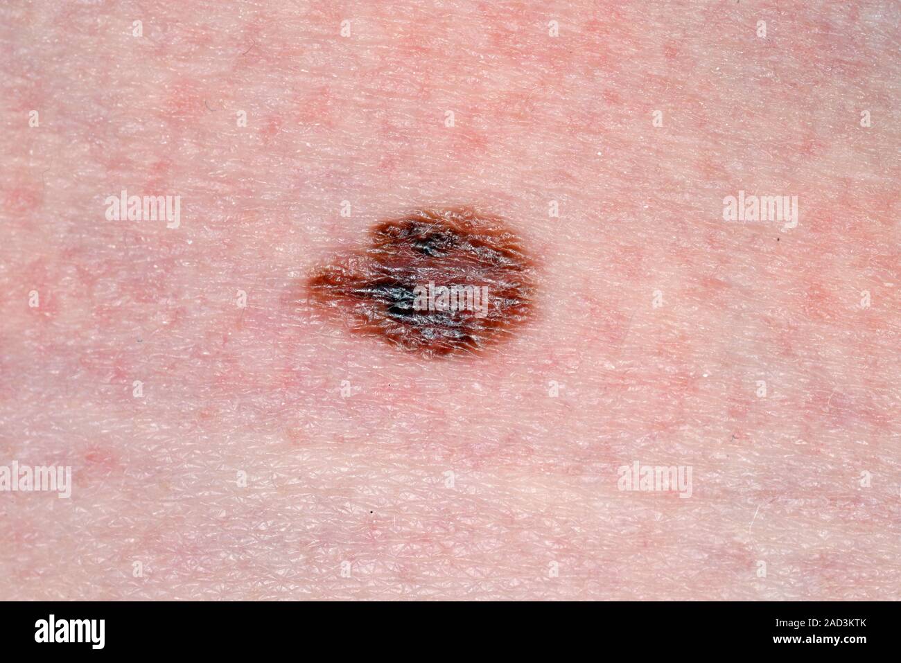 Atypical mole. Close-up of a dysplastic naevus, or atypical mole, on ...
