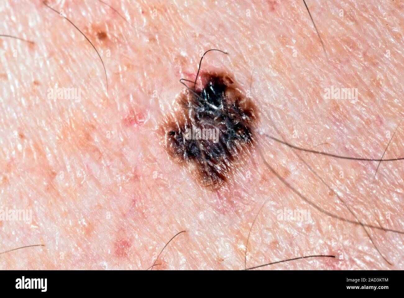 Seborrheic keratosis. Close-up of a seborrheic keratosis (seborrheic or ...