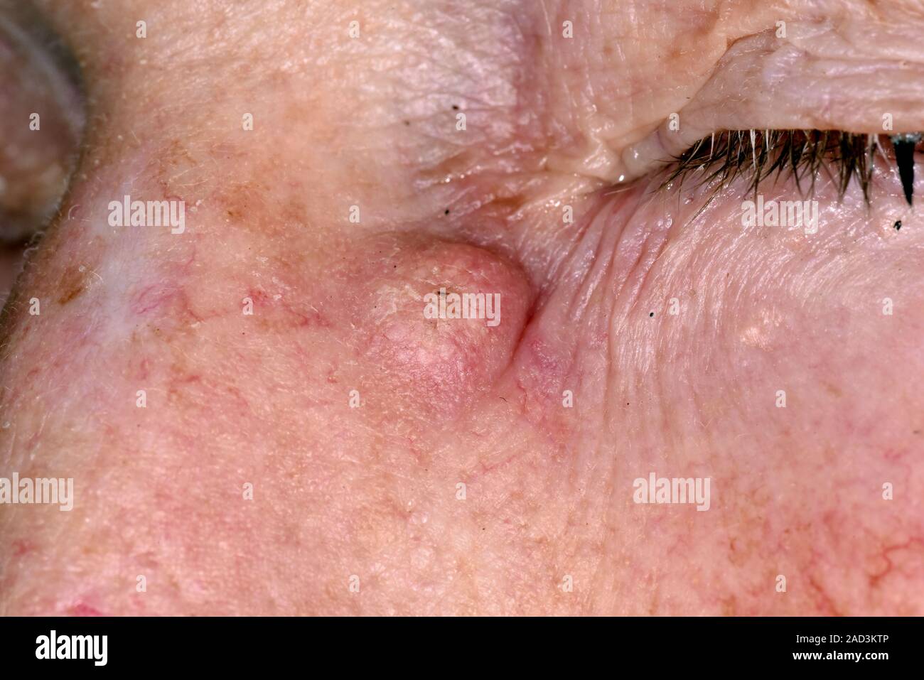 Keratoacanthoma skin cancer. Close-up of a keratoacanthoma below the ...