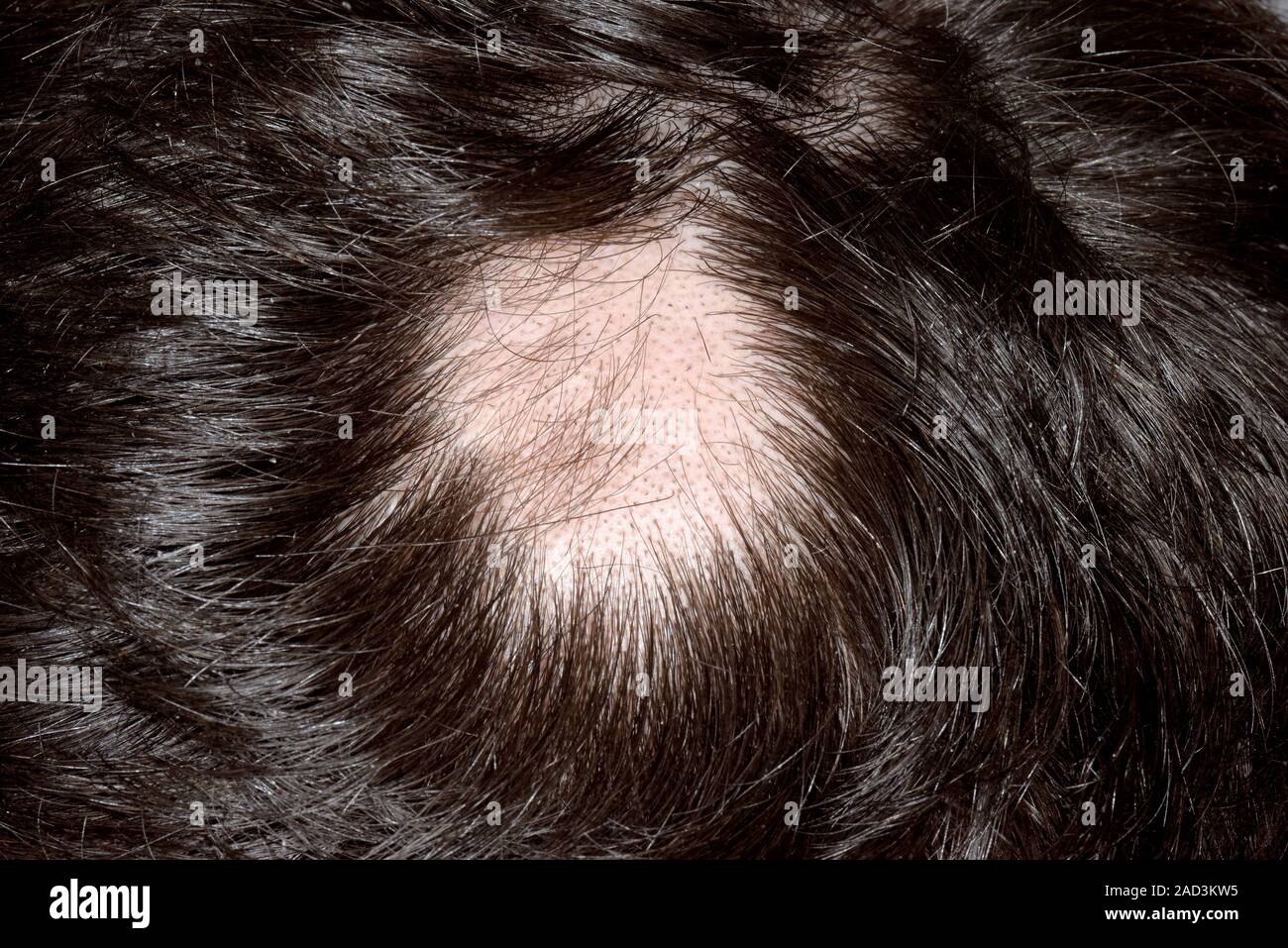 Hair loss. Close-up of the scalp of a 20-year-old male patient with ...