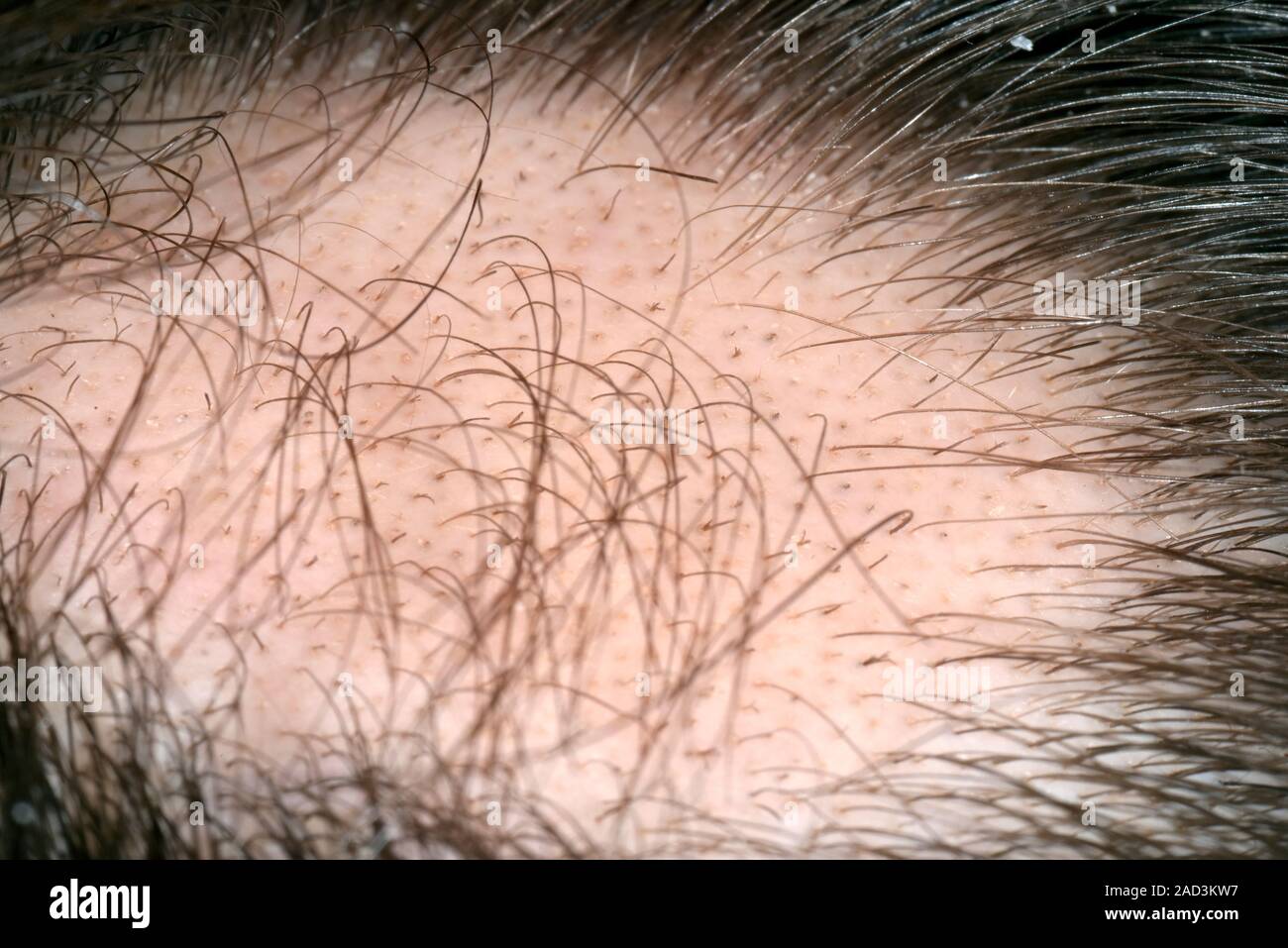 Hair loss. Close-up of the scalp of a 20-year-old male patient with ...