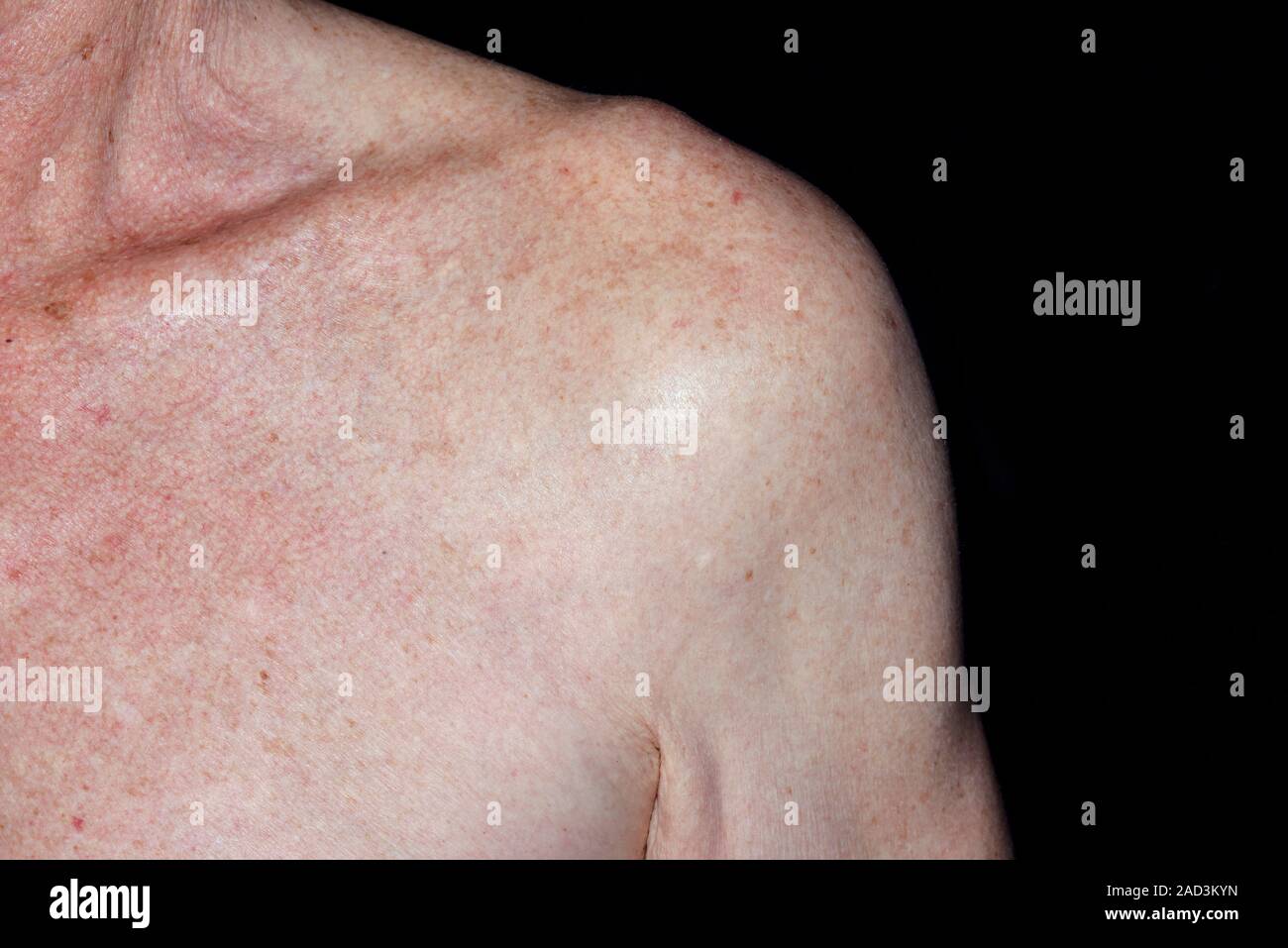 Shoulder effusion after fall. Close-up of the swollen shoulder of a 76 ...