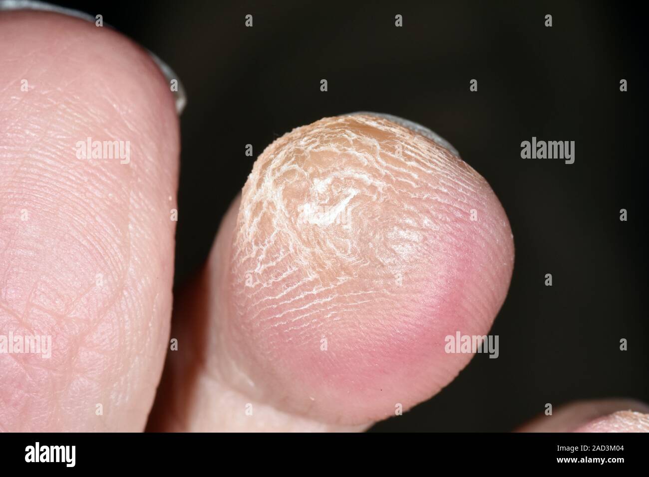 Callous on toe. Close-up of hardened skin (callous) on the underside of ...