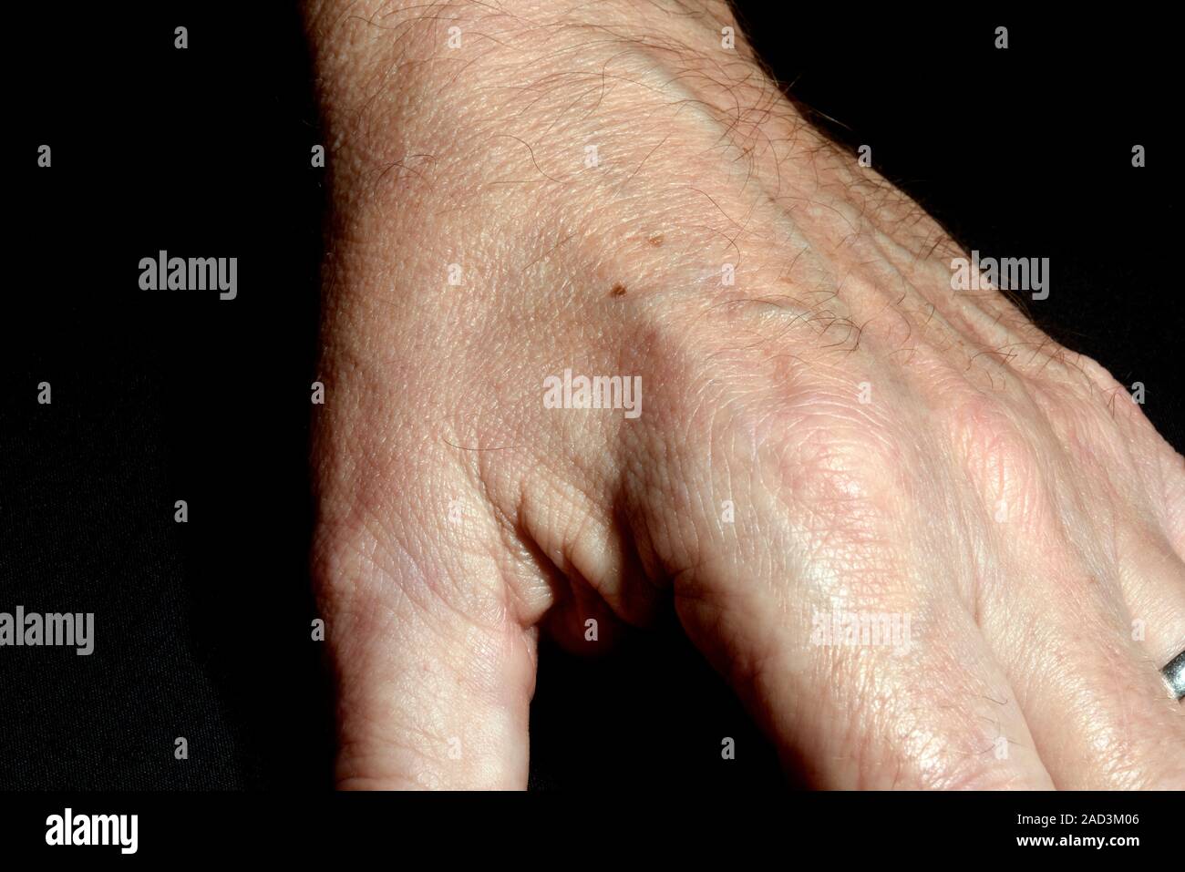 Muscle wasting after CABG surgery. Close-up of muscle wasting (atrophy ...