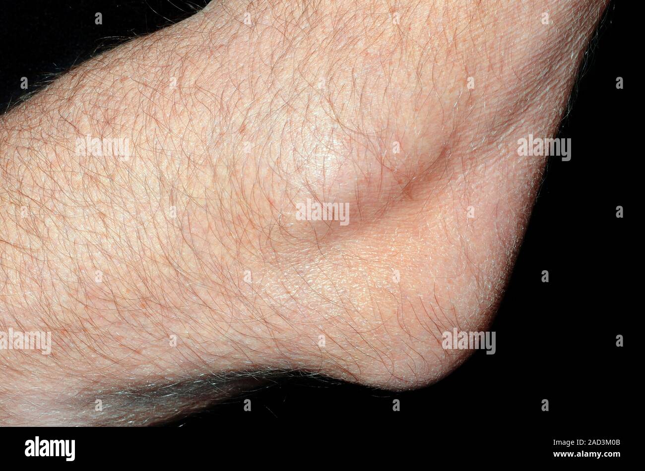 Bursitis of the elbow. Close-up of the inflamed elbow (olecranon) of a ...