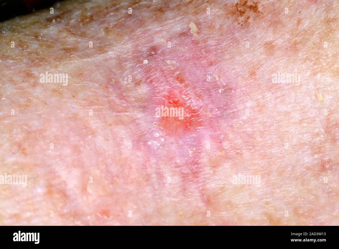 Basal-cell carcinoma skin cancer. Close-up of a superficial spreading ...