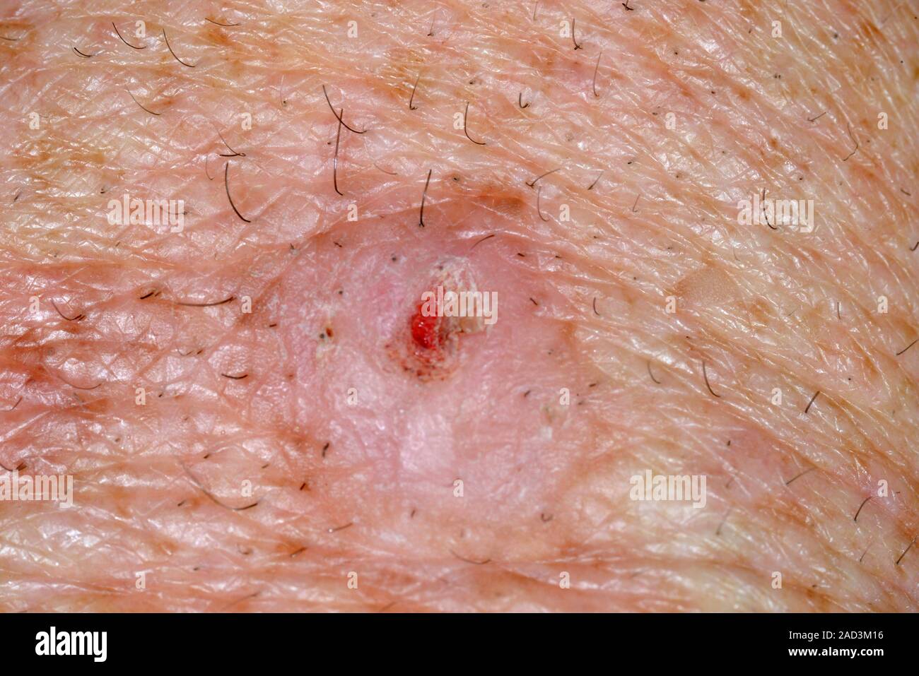 Basal-cell carcinoma skin cancer. Close-up of a basal-cell carcinoma ...