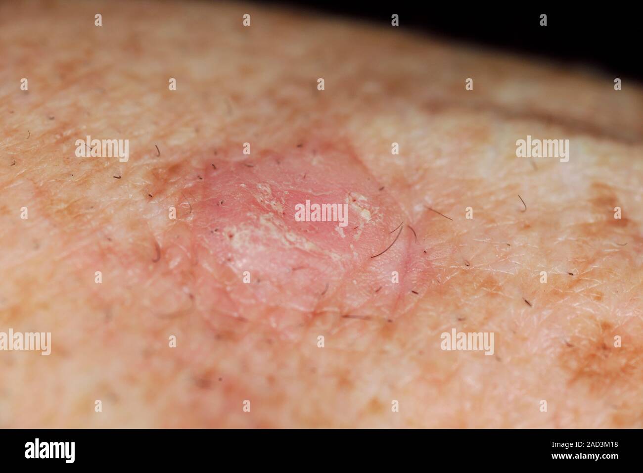 Basal-cell carcinoma skin cancer. Close-up of a basal-cell carcinoma ...