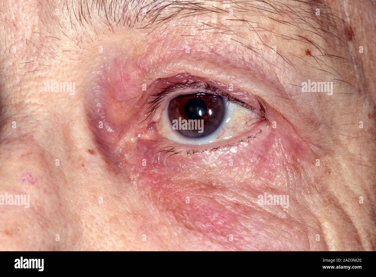 Swollen eye. Close-up of the eye of a 71-year-old female patient with ...