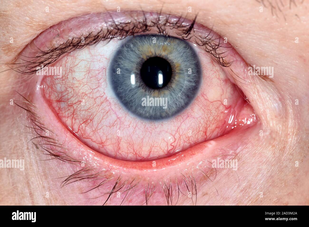 Episcleritis. Close-up of the bloodshot eye of a 36-year-old female ...