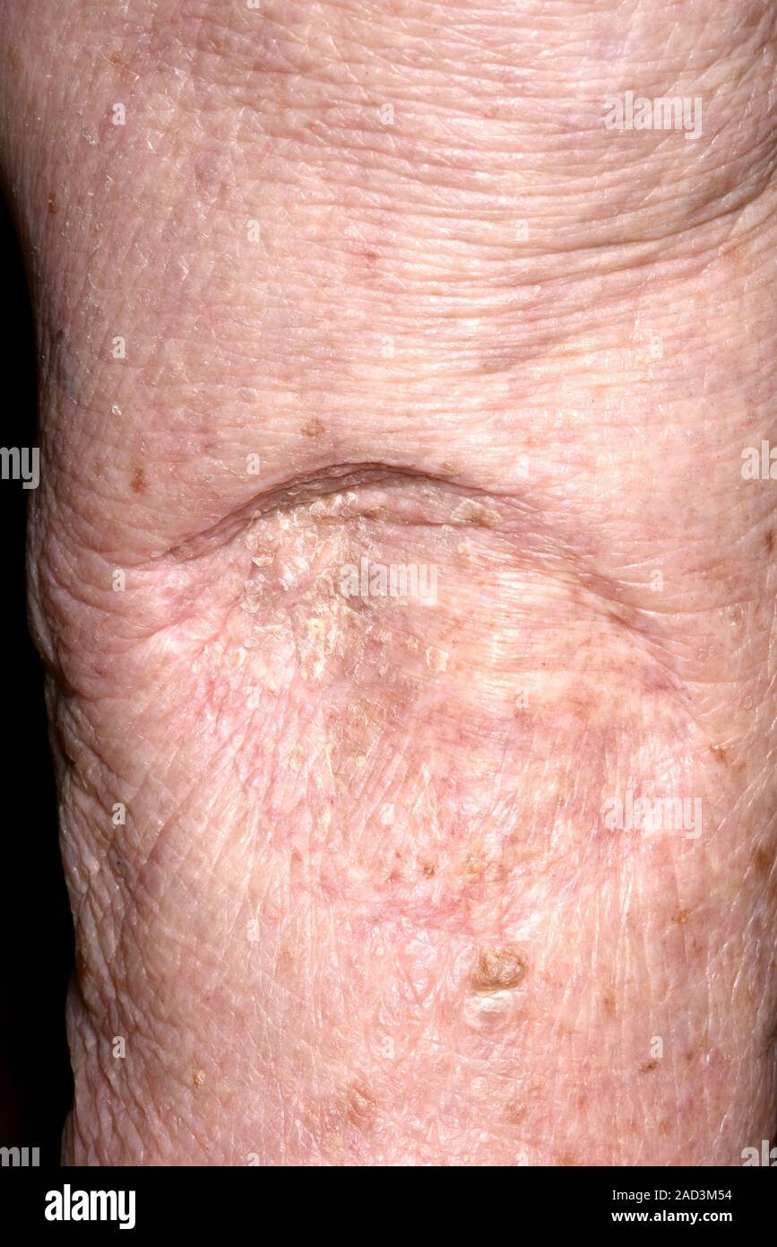 Scar after skin cancer removal. Close-up of a surgical scar on the leg ...