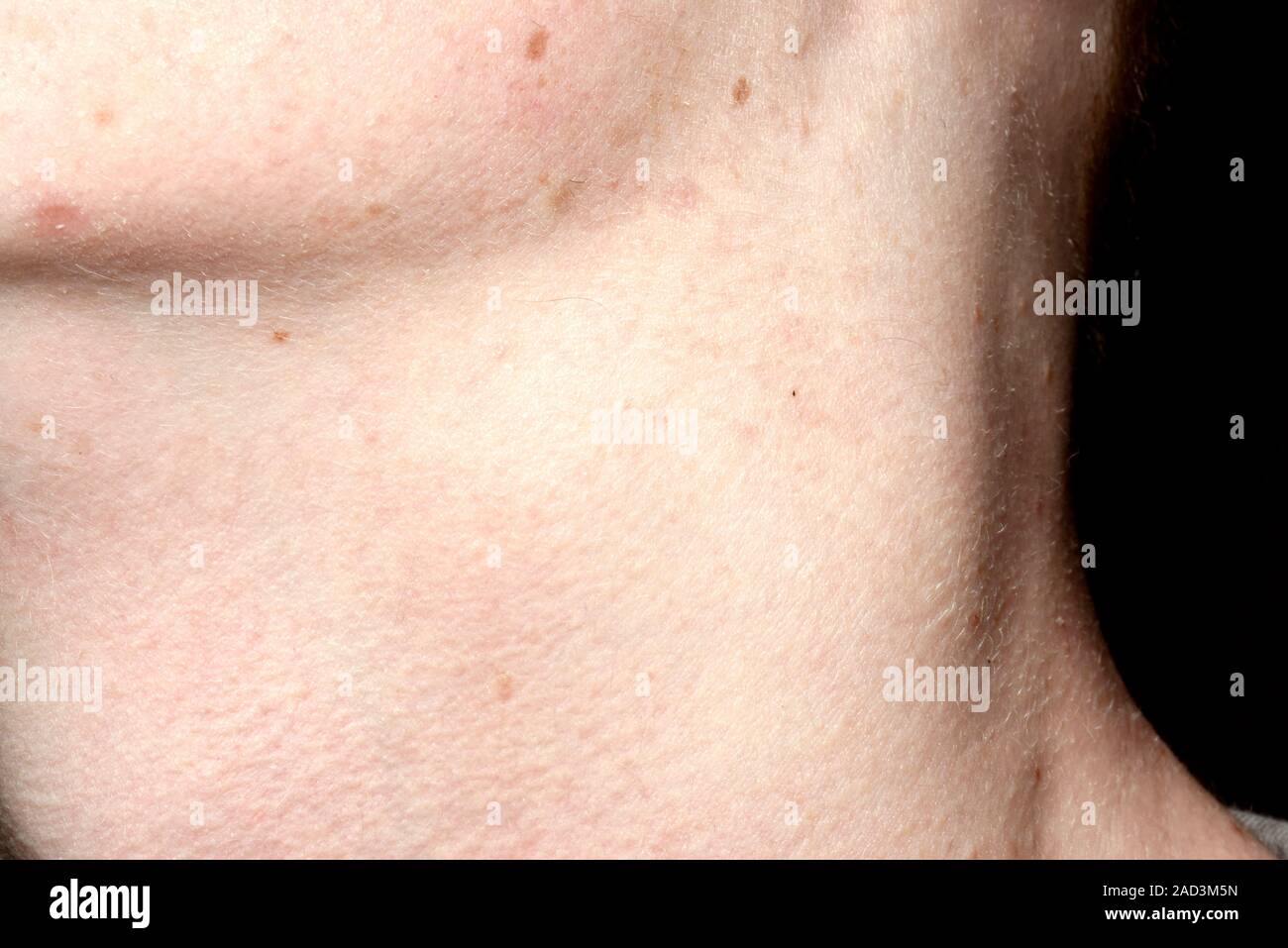 Enlarged lymph nodes. Close-up of the swollen neck of an 18-year-old ...