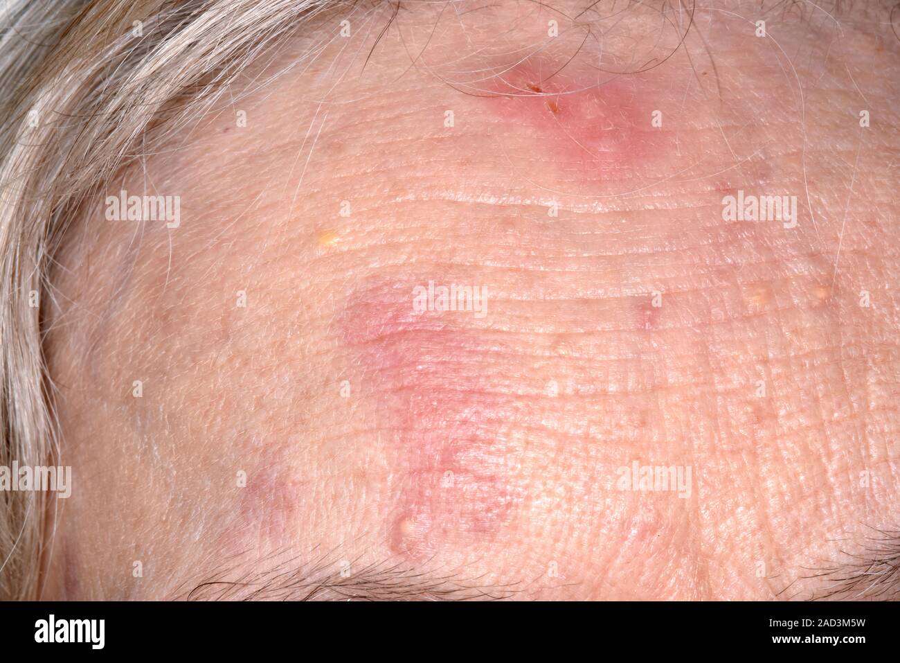Shingles Rash Close Up Of A Rash On The Forehead Of A
