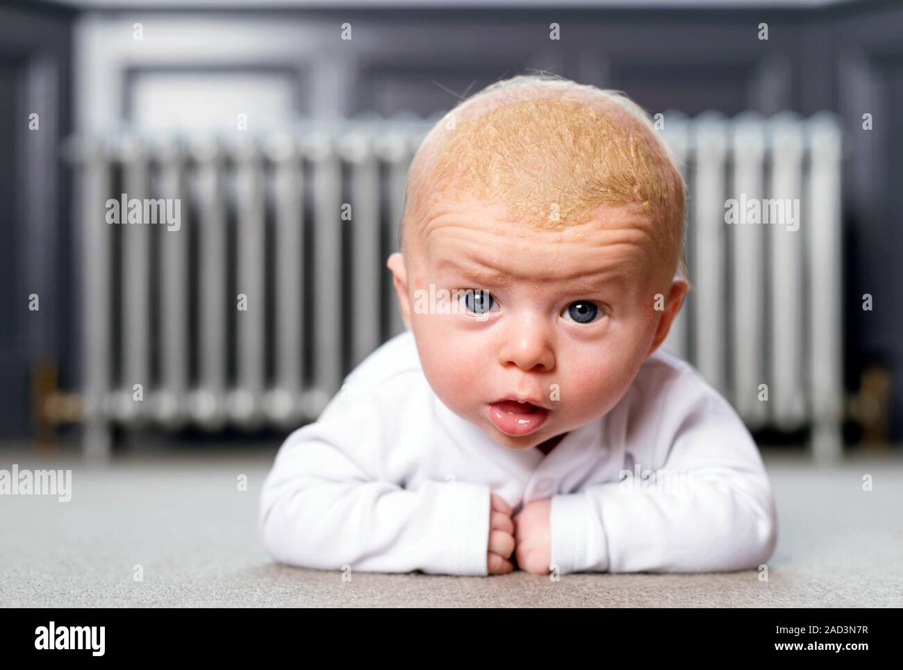 Baby with cradle cap. Two-month-old baby boy with cradle cap (crusta ...