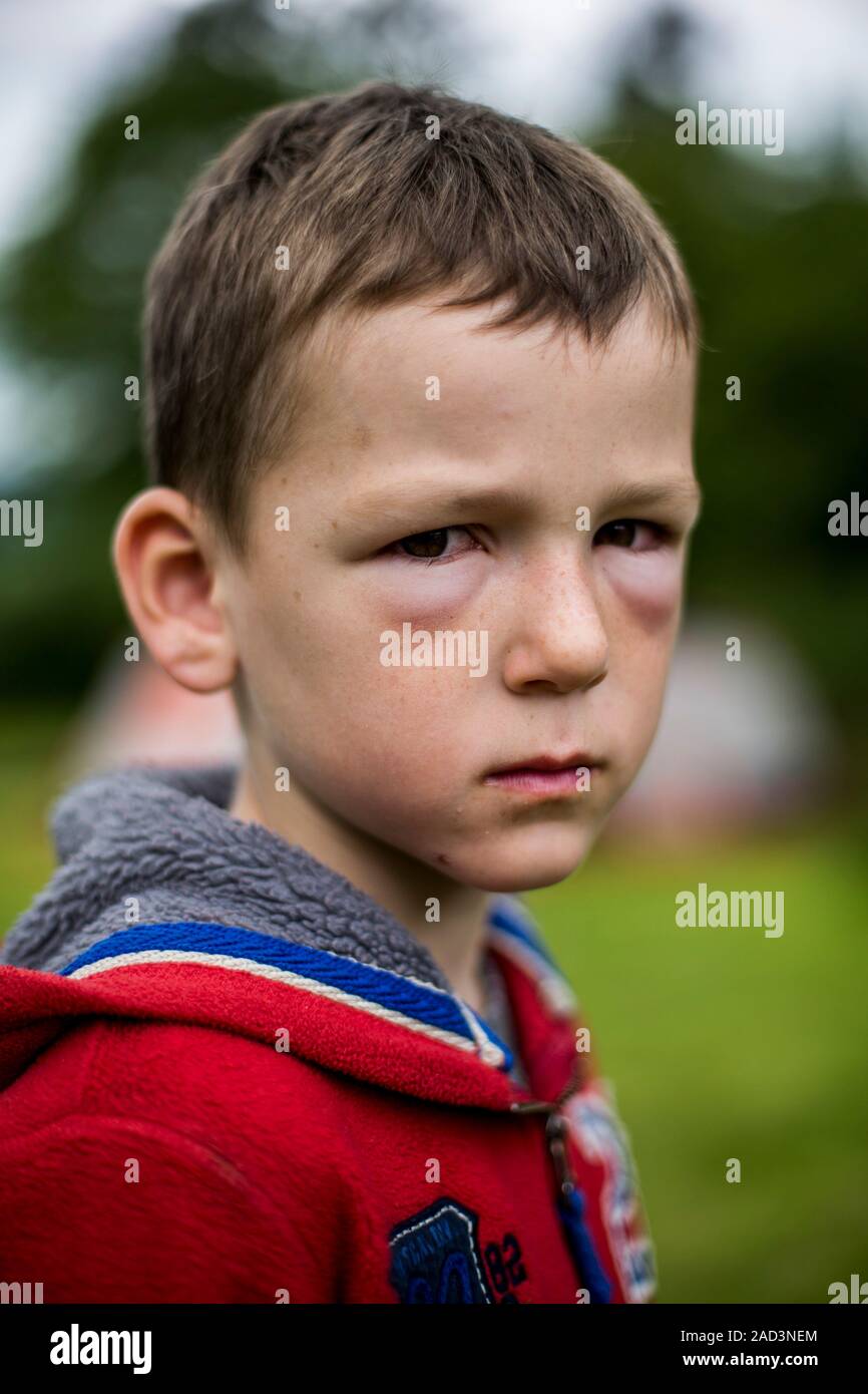 Boy with hay fever allergic reaction. 5-year-old boy with swollen ...