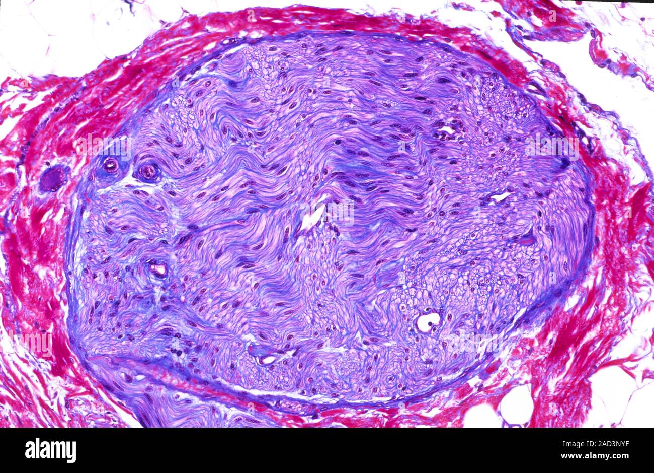 Light microscopy of a small peripheral nerve in cross section. The ...