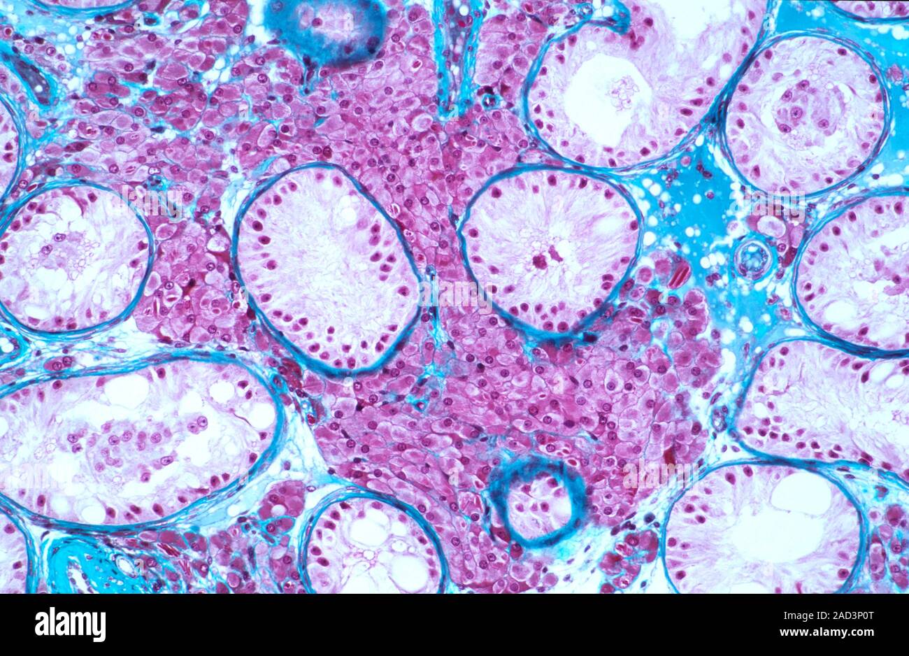 Light microscopy of human testis from a sterile individual in which ...