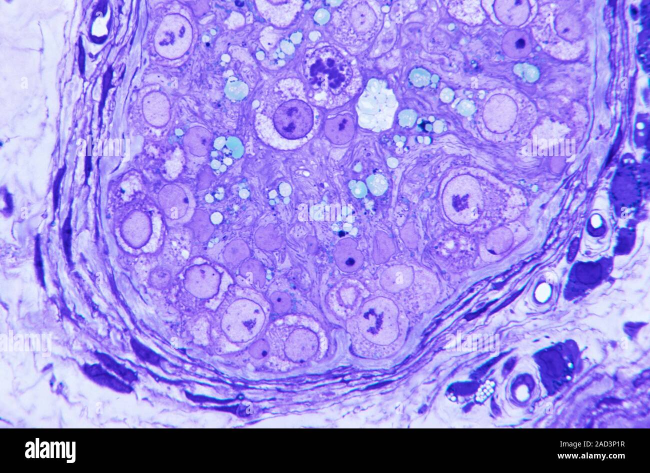 Testicular cancer. Light micrograph of a section through part of a ...