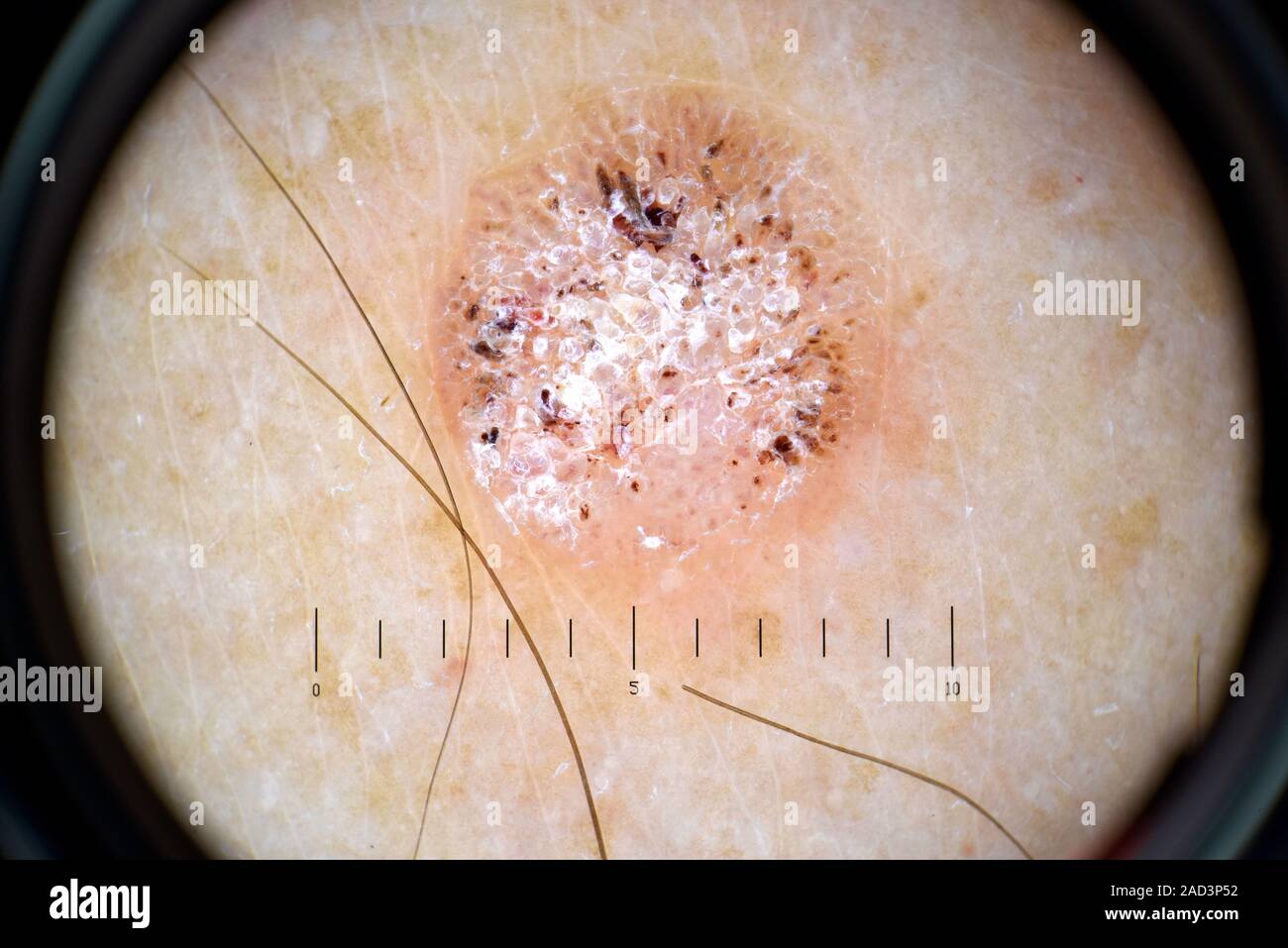 Seborrheic keratosis. Dermatoscope image of a seborrheic keratosis ...