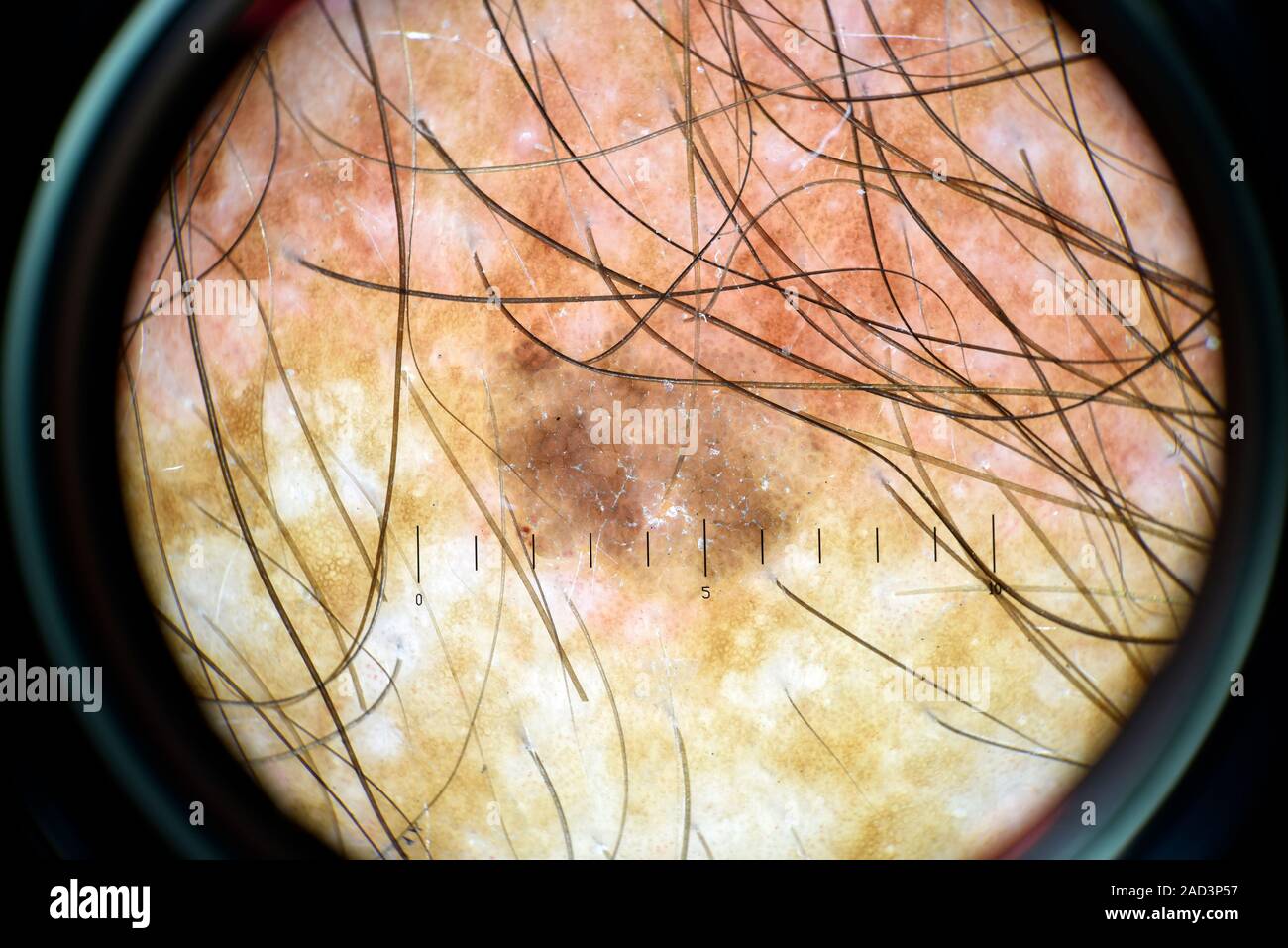 Mole. Dermatoscope image of a benign (non-cancerous) mole on the chest ...