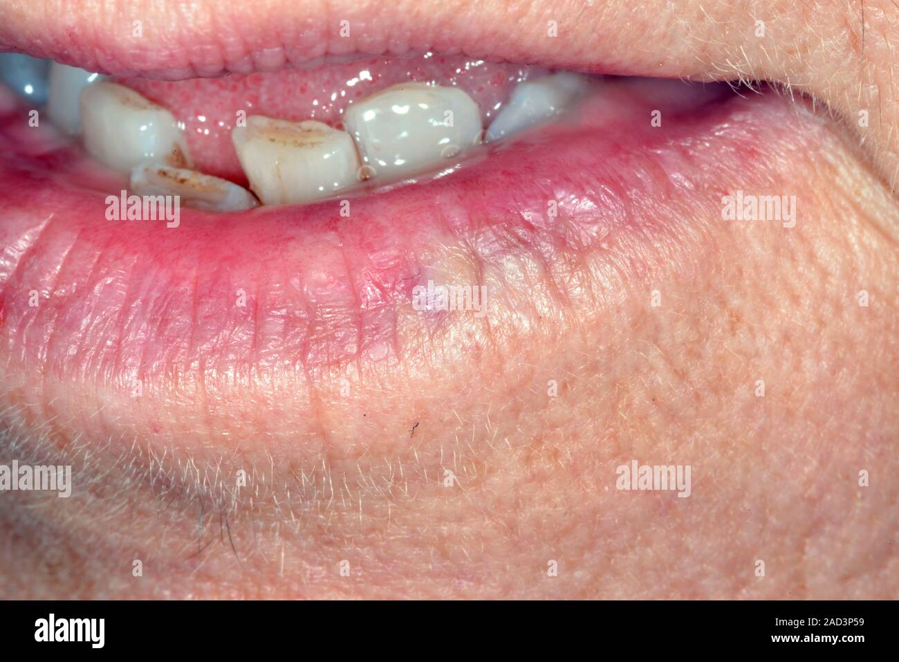 Solar Elastosis Close Up Of The Lip Of A 51 Year Old Female Patient With Solar Elastosis