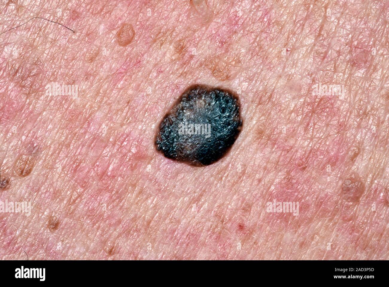 Seborrheic keratosis. Close-up of a seborrheic keratosis (seborrheic or ...