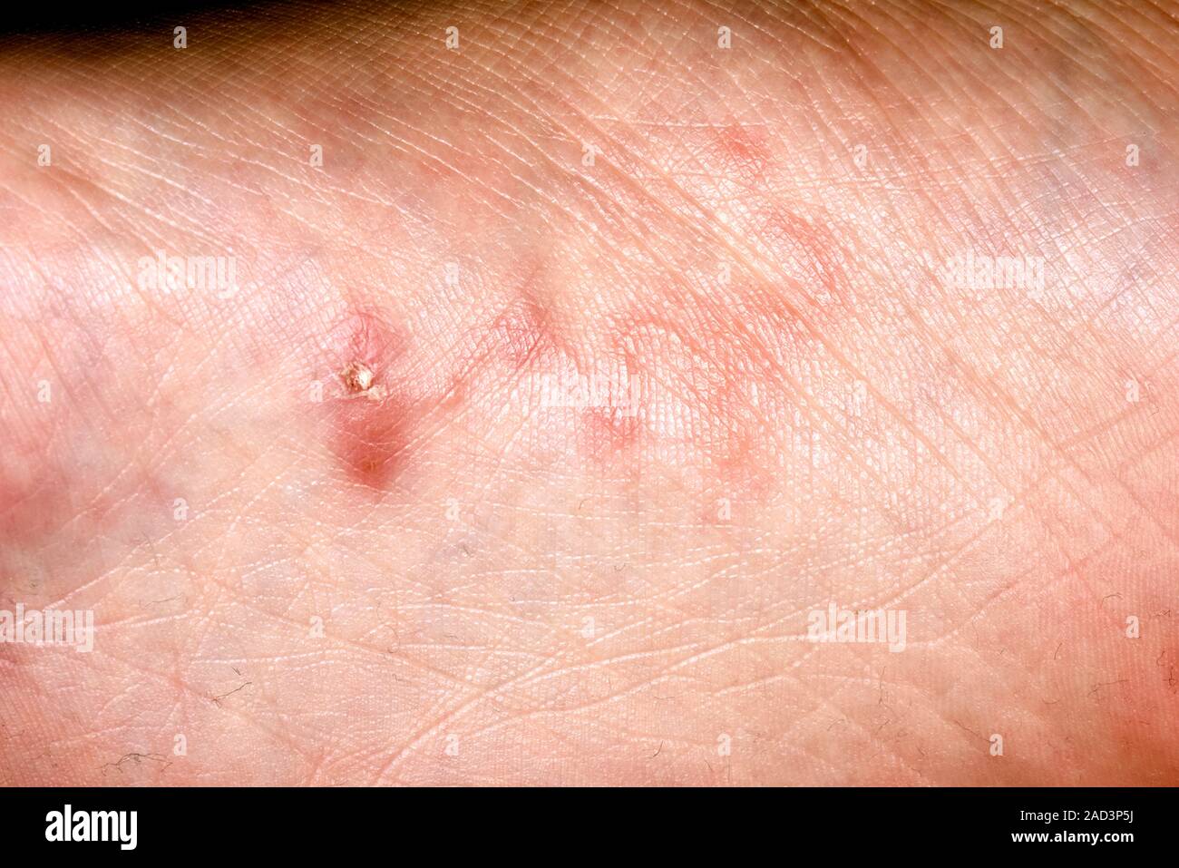 Larva migrans infection. Close-up of the skin of a 19-year-old female ...