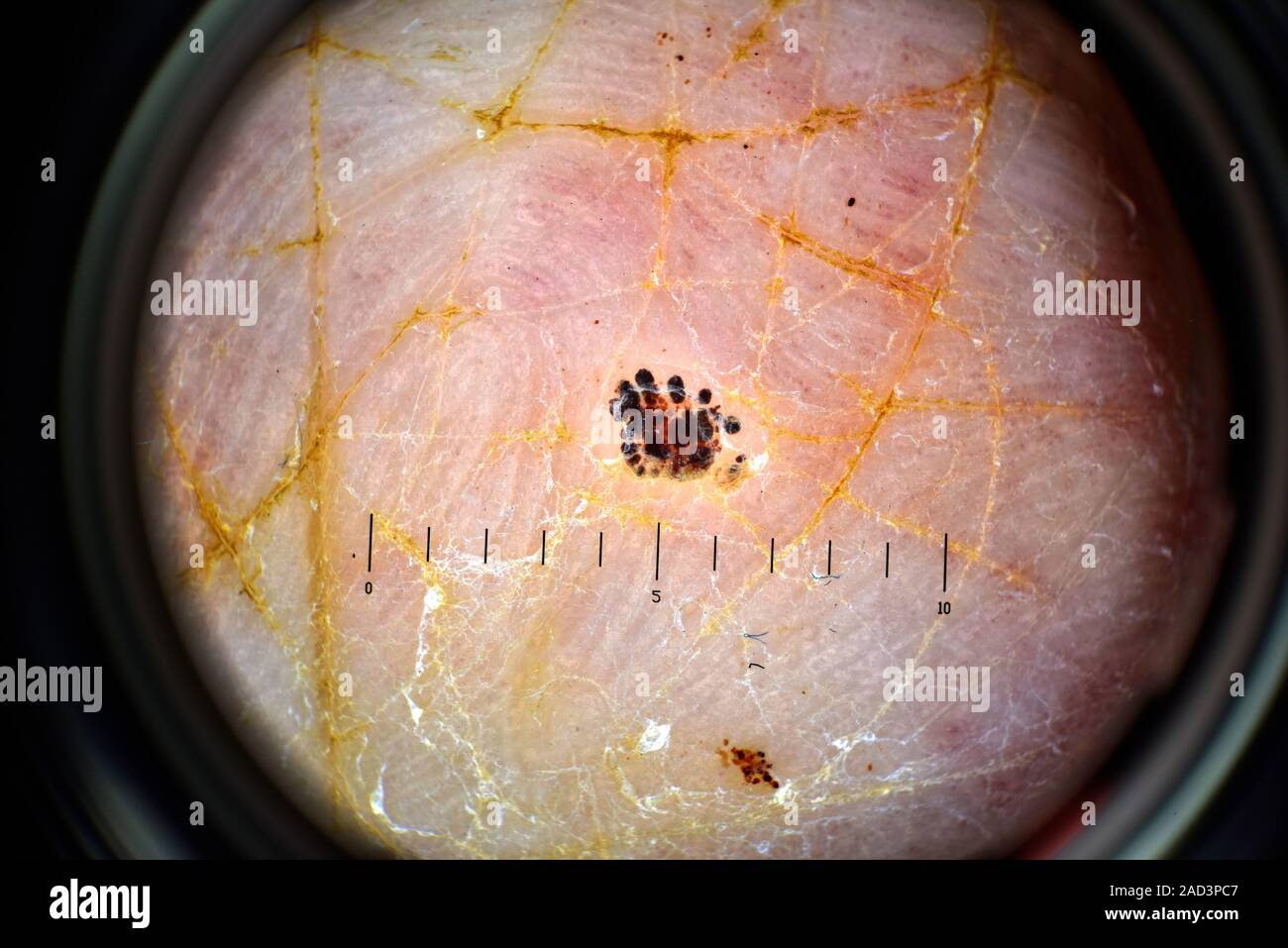 Thumb haematoma. Dermatoscope image of a small haematoma (localised ...