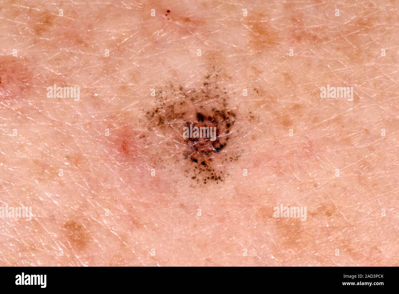 Post-inflammatory skin pigmentation. Close-up of a pigmented skin ...